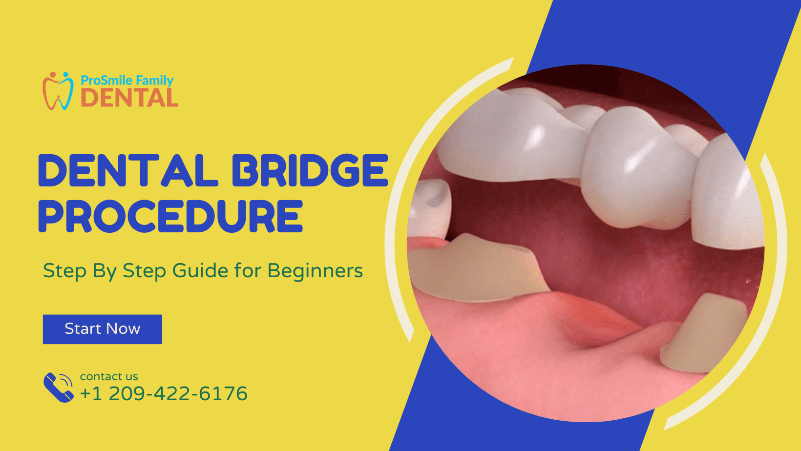 Family Dentist Modesto Blog - Expert Dental Care Tip