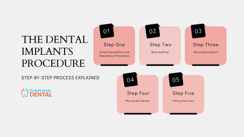 Dental Implant Procedure - The Ultimate Guide [2023]